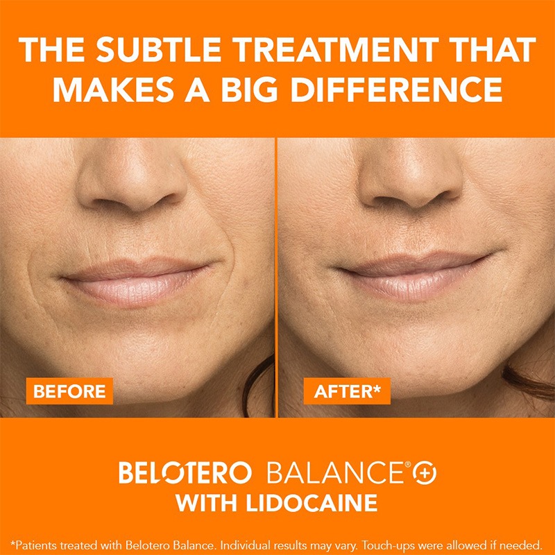 Belotero Balance with Lidocaine Dermal Filler By Merz Aesthetics ...