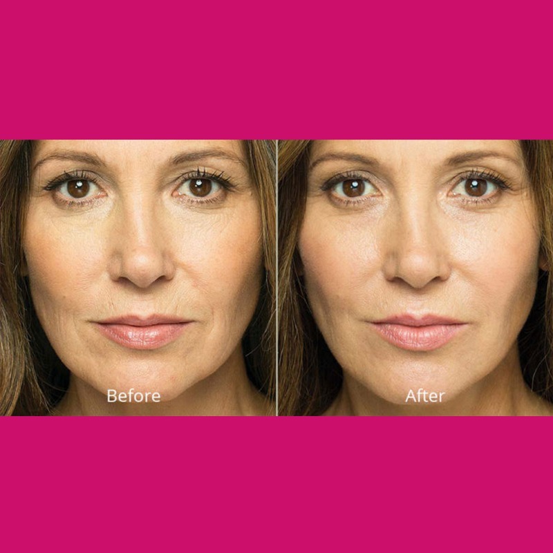 Belotero Intense Dermal Filler by Merz Aesthetics - AestheticsRX Pharma