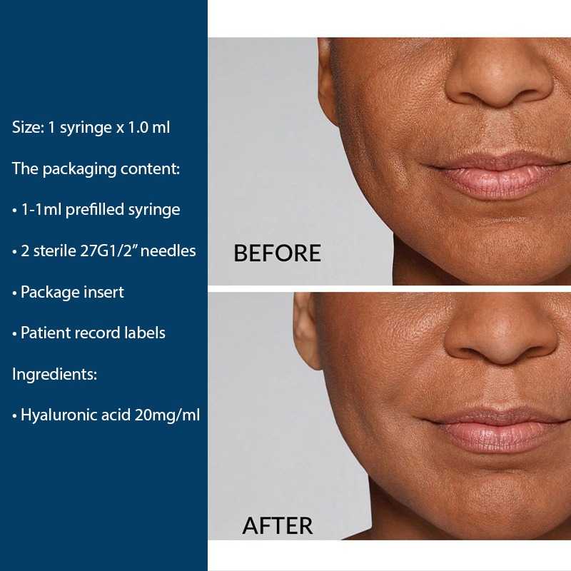 Restylane Defyne Lidocaine Dermal Filler - AestheticsRX Pharma
